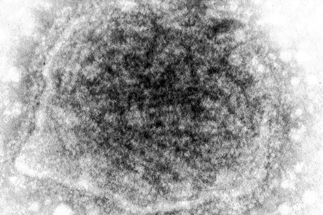 Oreionul sau parotidita epidemica - BodyGeek