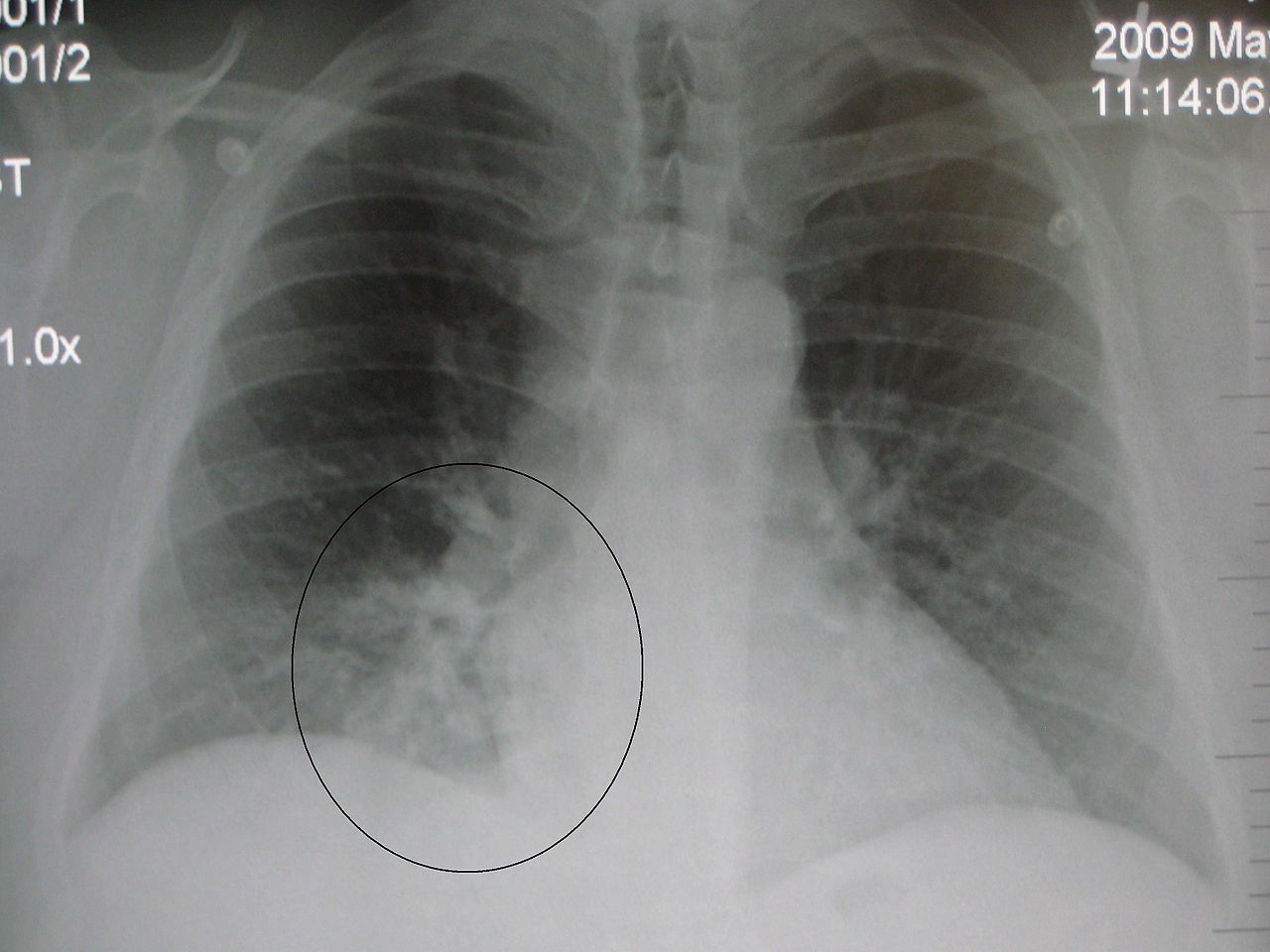 Pneumonia - BodyGeek