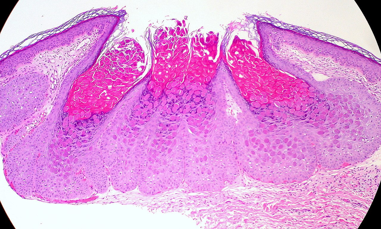 Afla metodele de tratament pentru Molluscum Contagiosum, o boala virala ...