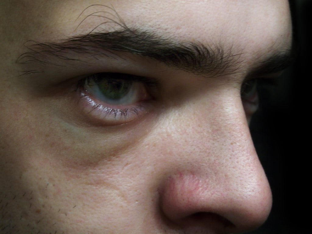 Pungi de grasime sub ochi, un disconfort pentru femei - BodyGeek